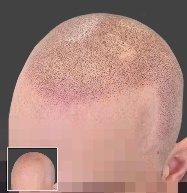 Scalp Micropigmentation Clinic In Cincinnati | Scalp Micro Cincy